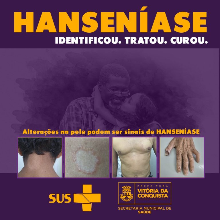 Janeiro Roxo: alerta para o combate e prevenção da Hanseníase ...